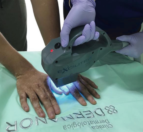 Excilite u – Láser Excímer (DEKA) – Dermanor