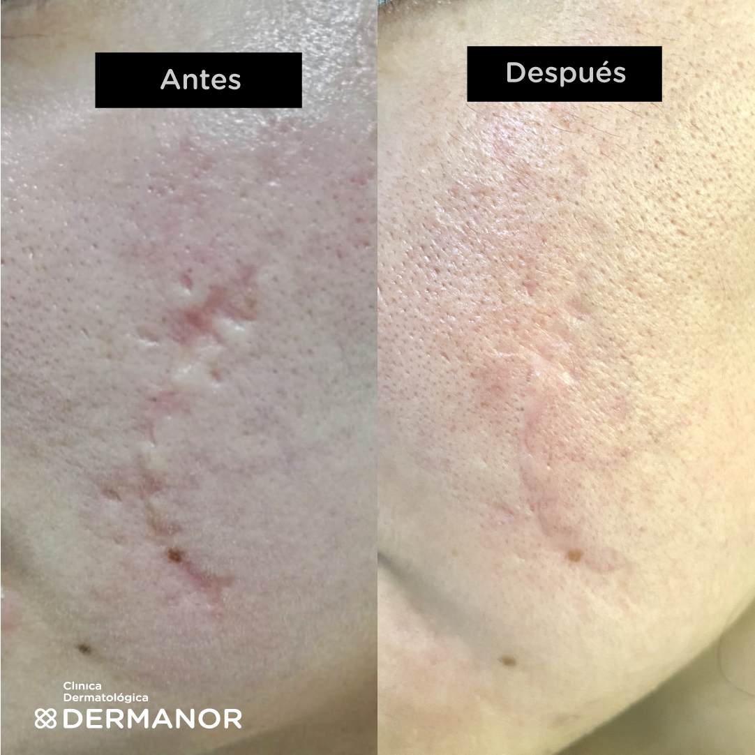Cicatrices – Dermanor